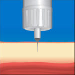 Injection Tips & Techniques | Facet Medical Technologies