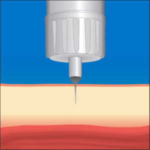 Injection Tips & Techniques | Facet Medical Technologies